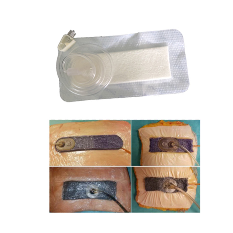 Negative Pressure Wound Therapy One Piece NPWT Dressing Kit with Port