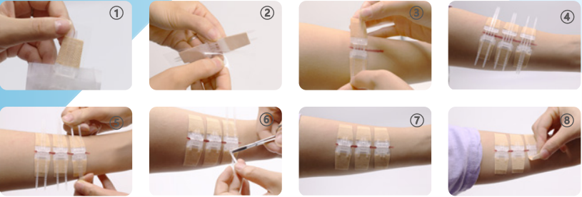 Zip stitch laceration kit surgery skin closure device
