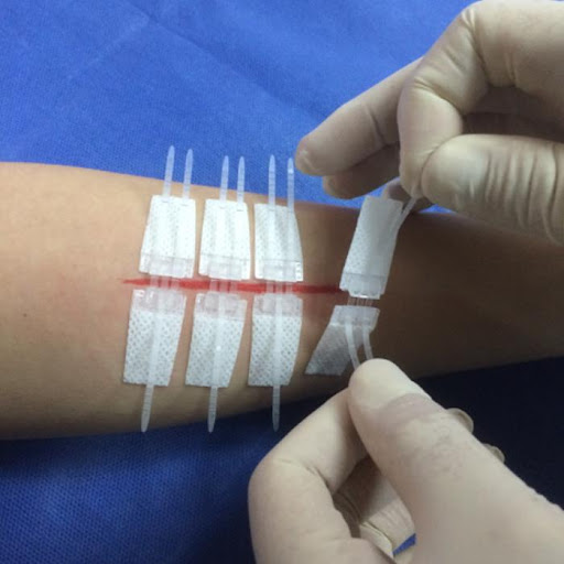 Wound closure without stitches relieves painful of wound suture