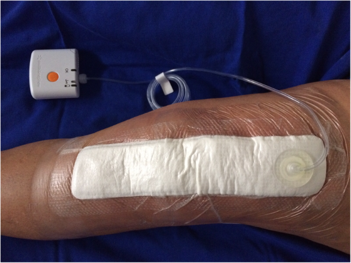 What Is A Negative Pressure Wound Therapy Device at Phoebe Doane blog