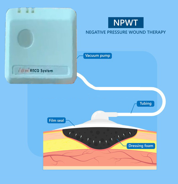 Npwt negative pressure wound therapy negative pressure wound treatment