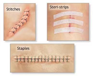 skin closure strips suture strips for wound