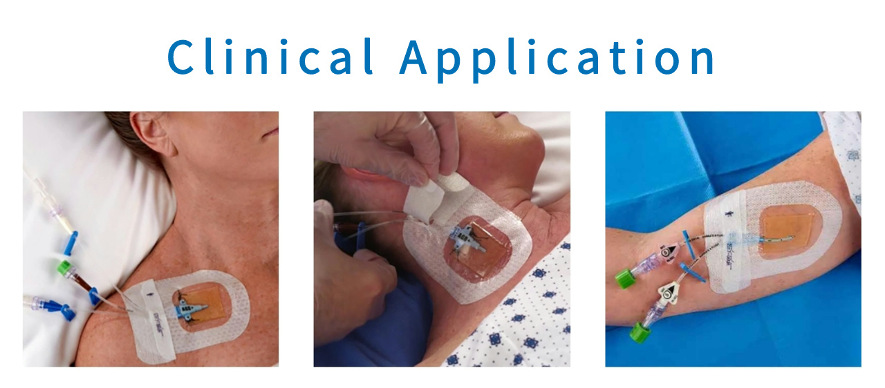 CHG Chlorhexidine Gluconate Dressing IV Port Dressings