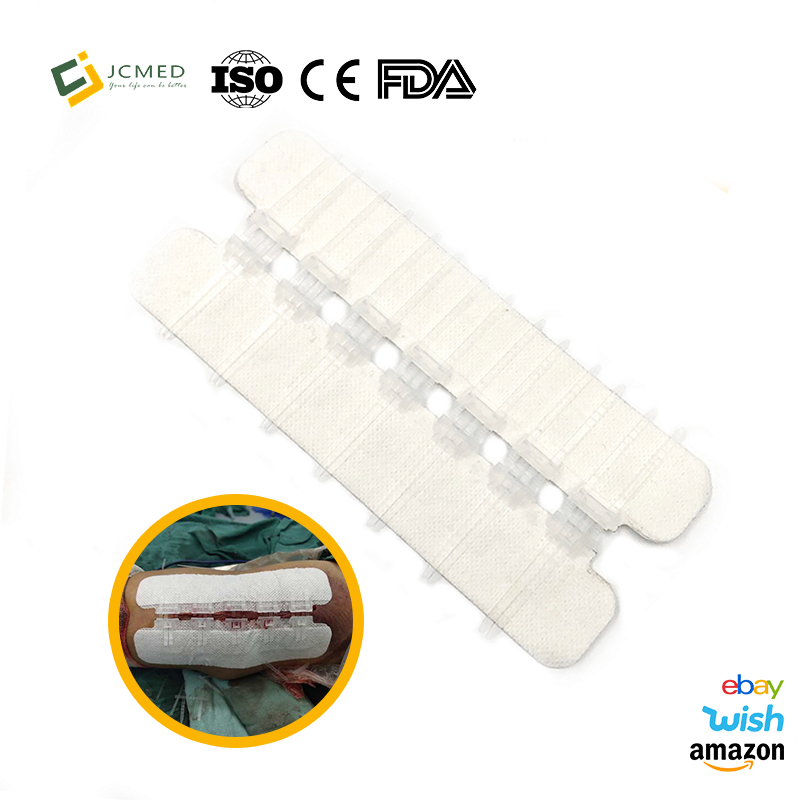 Wound closure without stitches relieves painful of wound suture